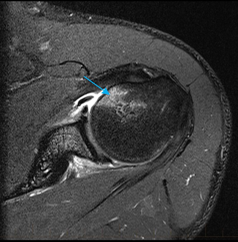 Radiology Mri Shoulder